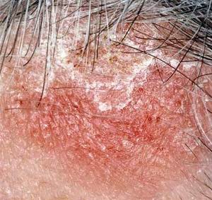 Seboroická dermatitída | eOtazky.sk